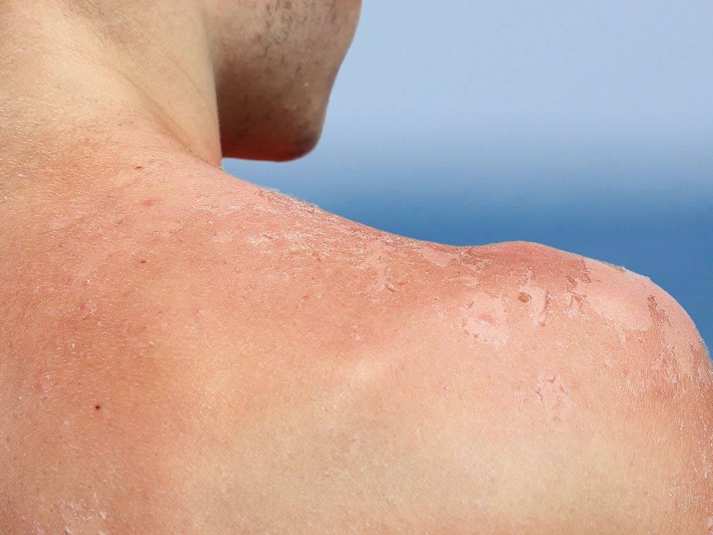 How to Soothe Sunburned Skin & Prevent Long-Term Damage