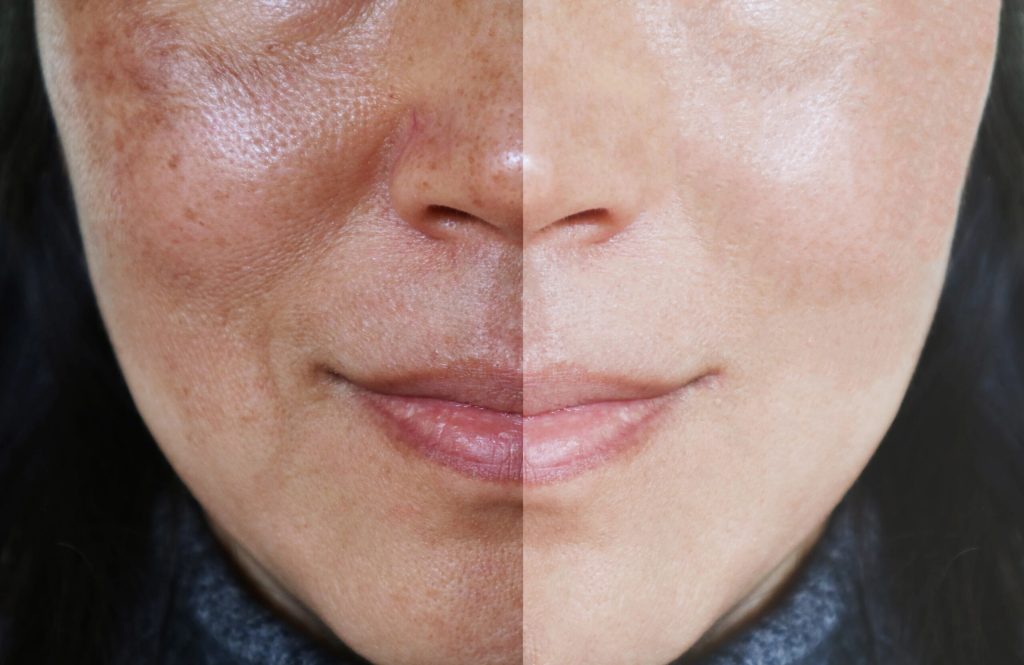 From Patchy to Perfect: How to Tackle Uneven Skin Tone - All Collective ...